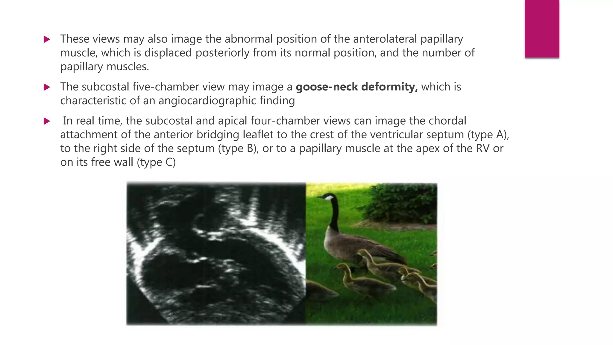 Endocardial Cushion Defect Avsd Ppt