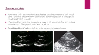 Endocardial Cushion Defect / AVSD | PPTX