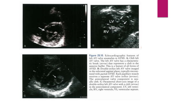 Endocardial Cushion Defect Avsd Ppt