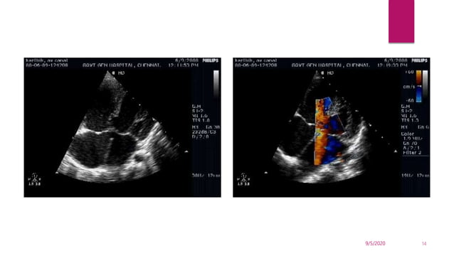 Endocardial Cushion Defect / AVSD | PPTX