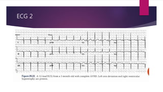 Endocardial Cushion Defect / AVSD | PPTX