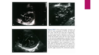 ecd-in congenital heart diseases PANDEY.pptx