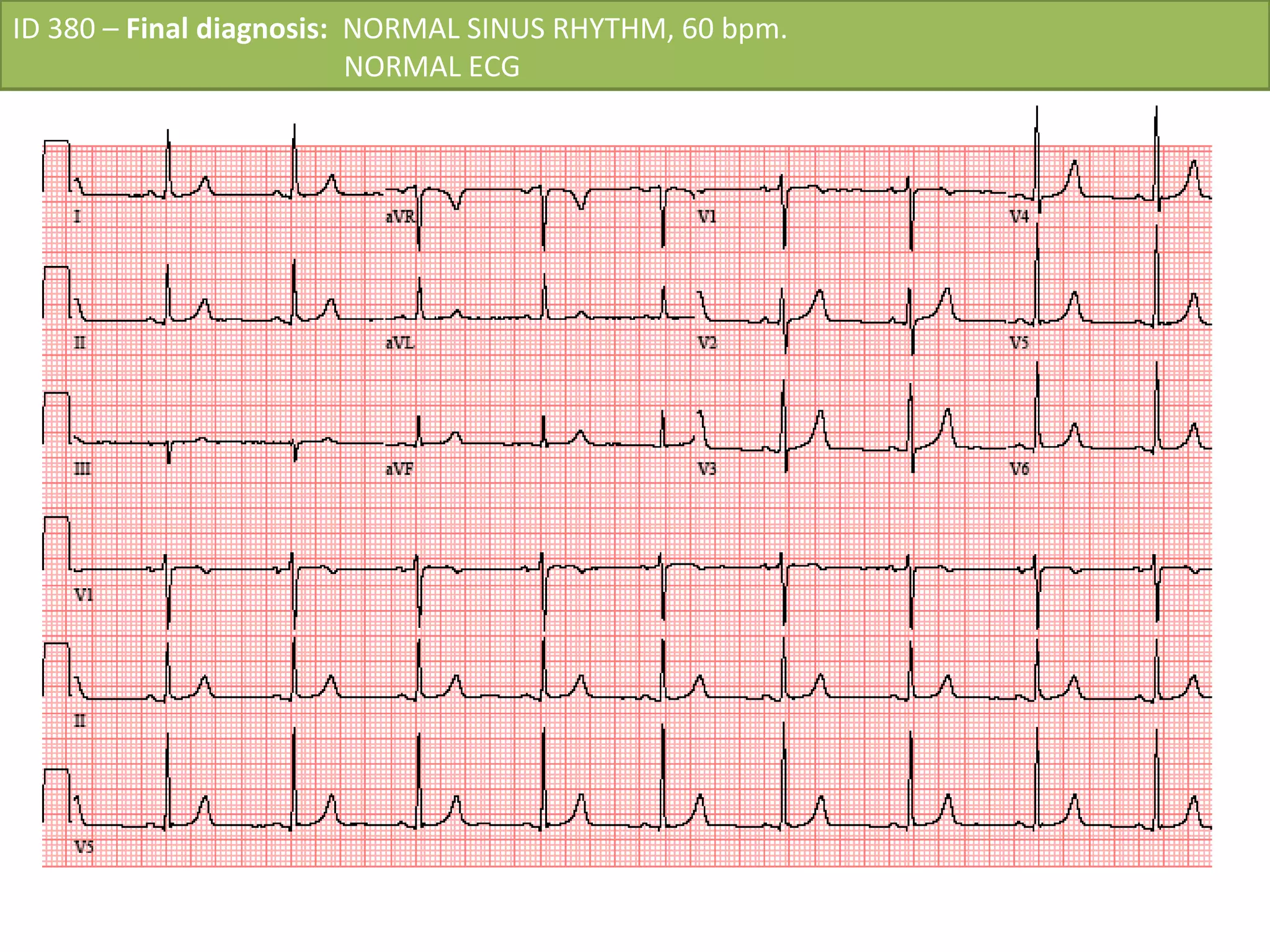 ECG #1 - ID 380 – Normal ECG | PPT | Heart and Cardiovascular Diseases ...