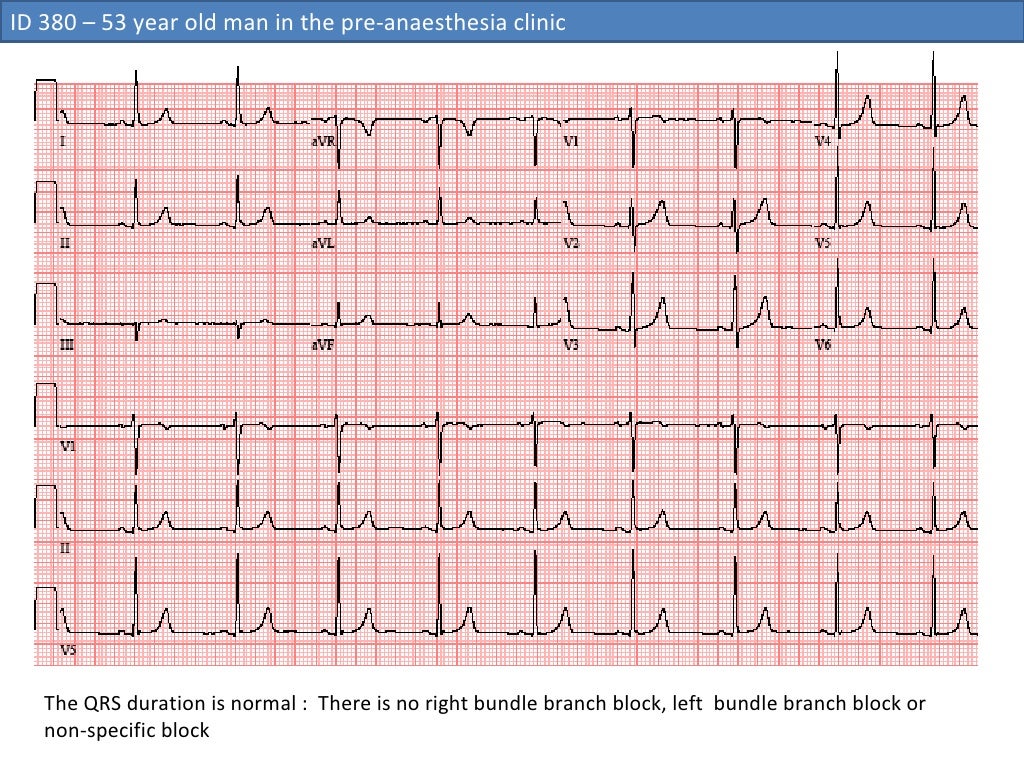 ECG 1 ID 380 Normal ECG ecg-1-id-380-normal-ecg