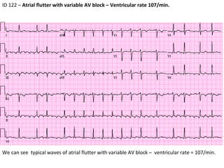 ECG #10 - ID122 - Atrial Flutter | PPT
