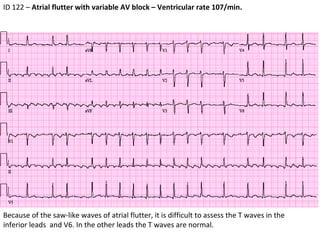 ECG #10 - ID122 - Atrial Flutter | PPT
