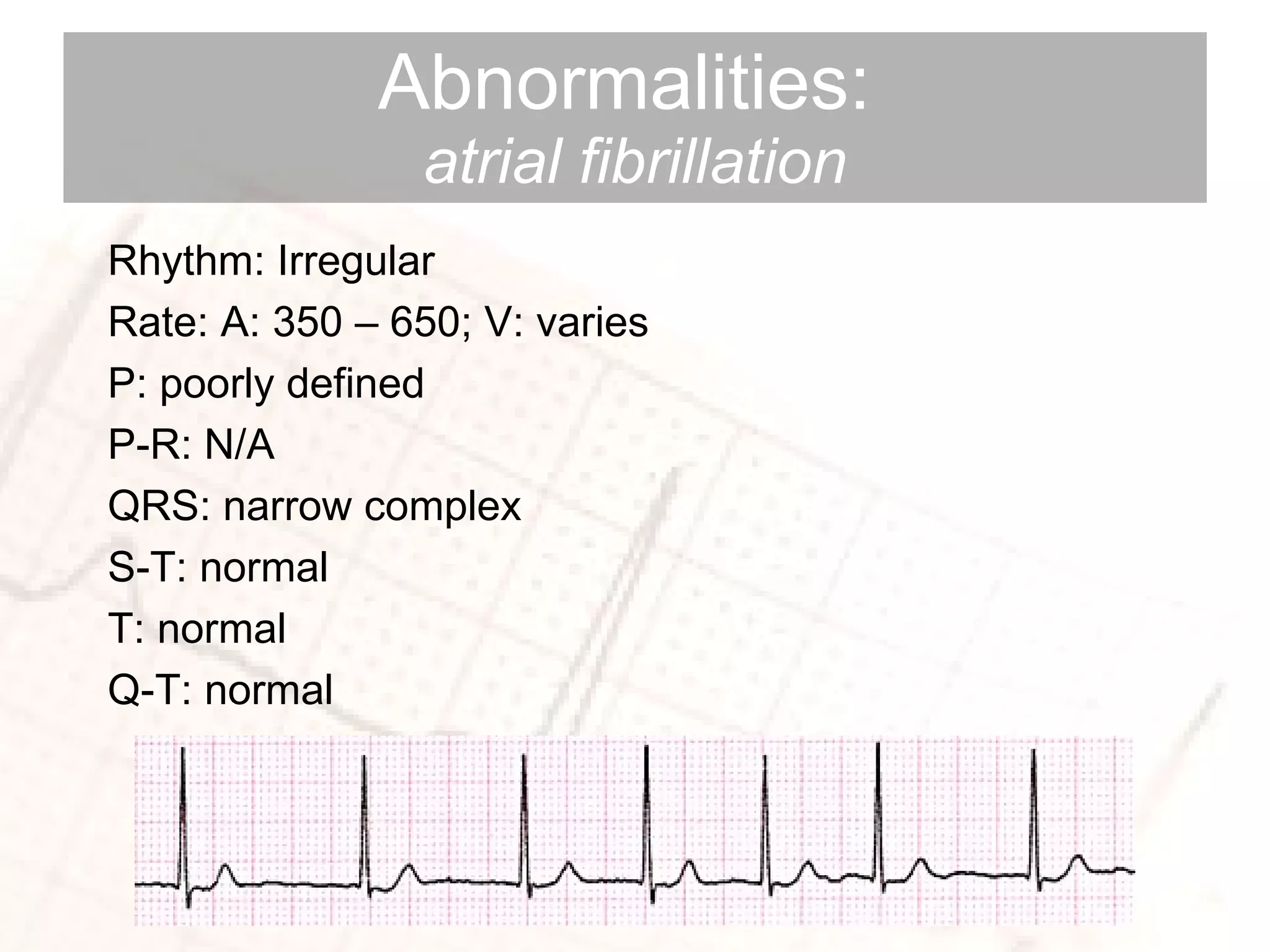 ECG interpretation: the basics | PPT
