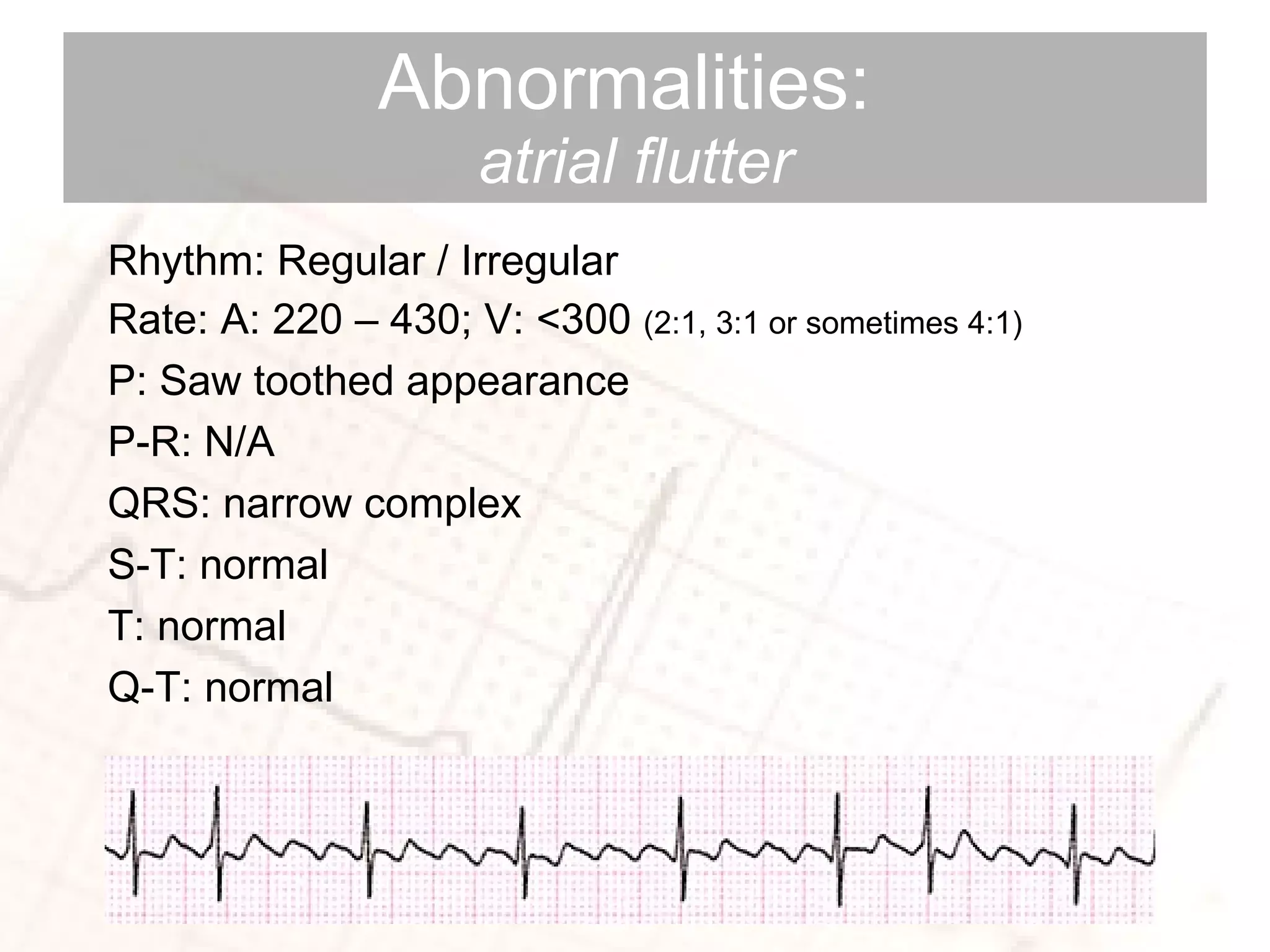 ECG interpretation: the basics | PPT