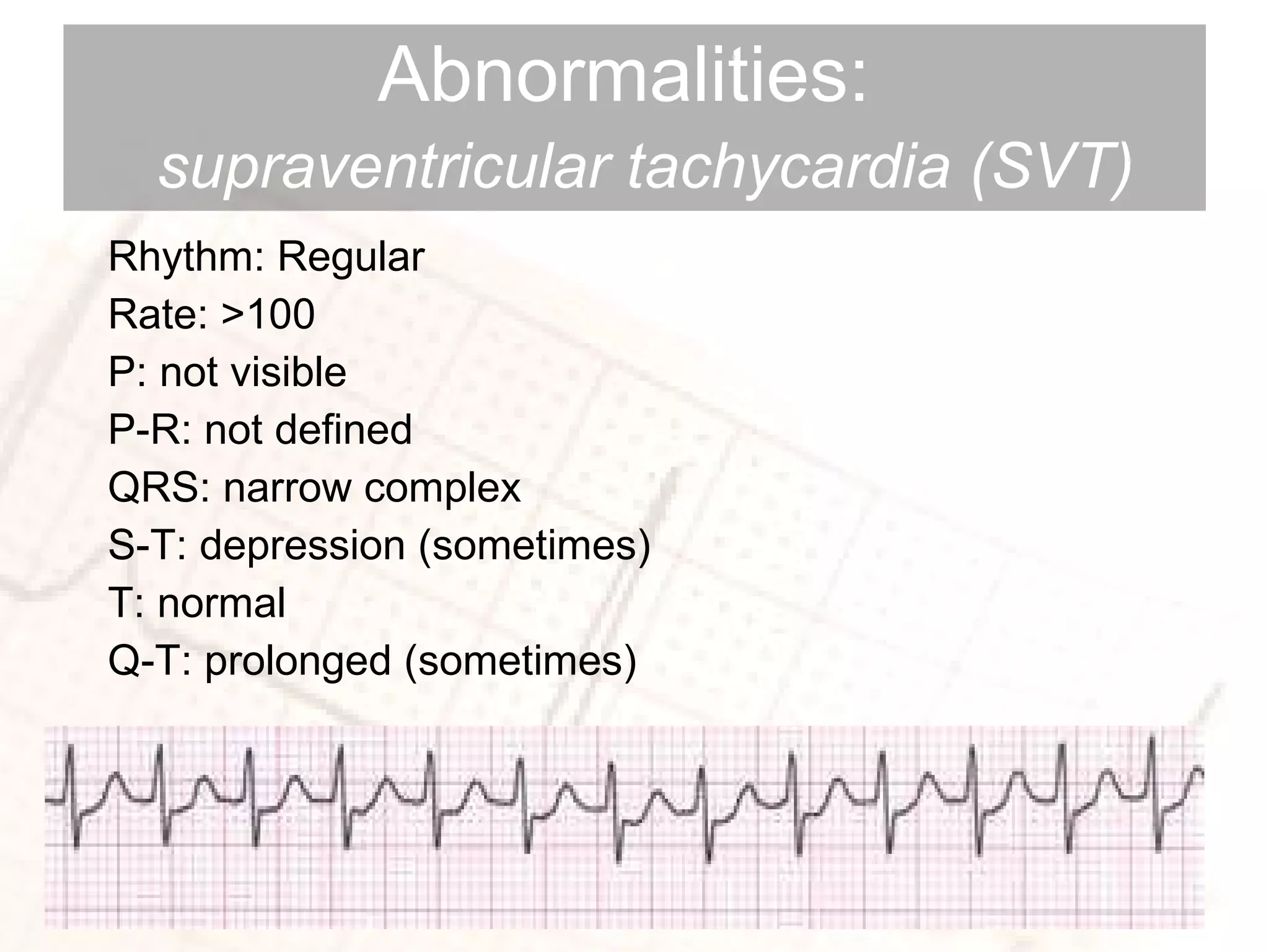 ECG interpretation: the basics | PPT