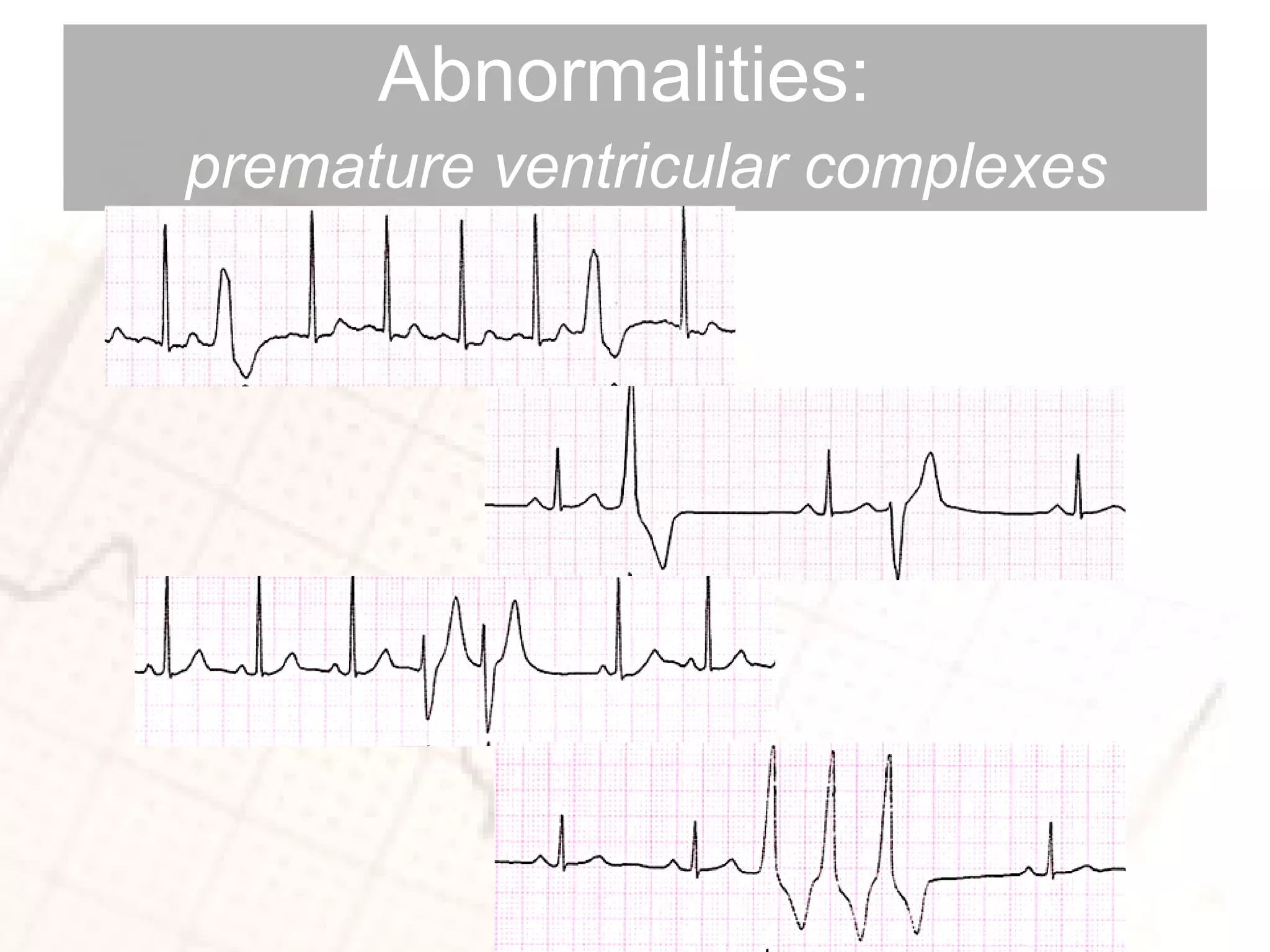 ECG interpretation: the basics | PPT