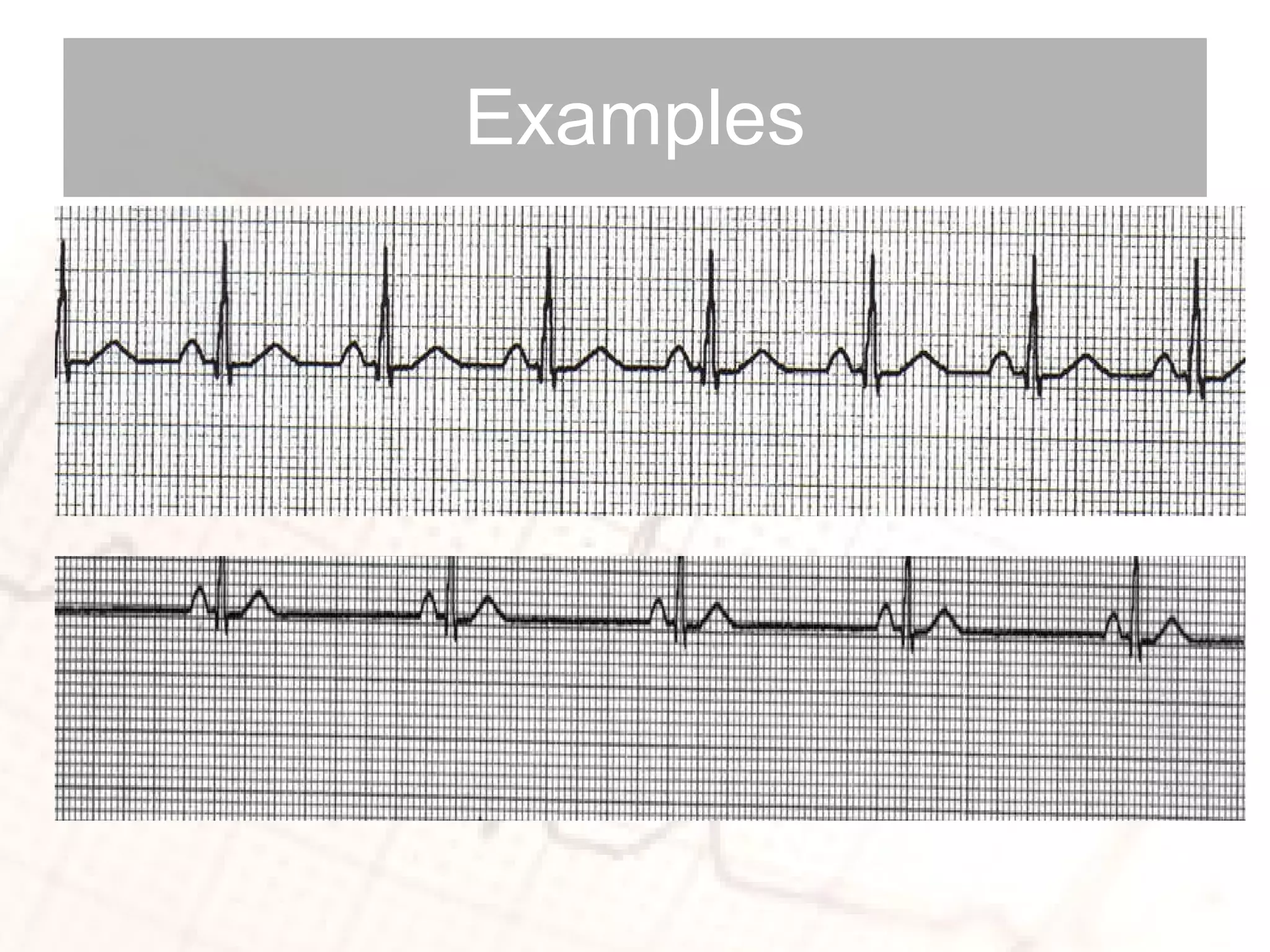 ECG interpretation: the basics | PPT