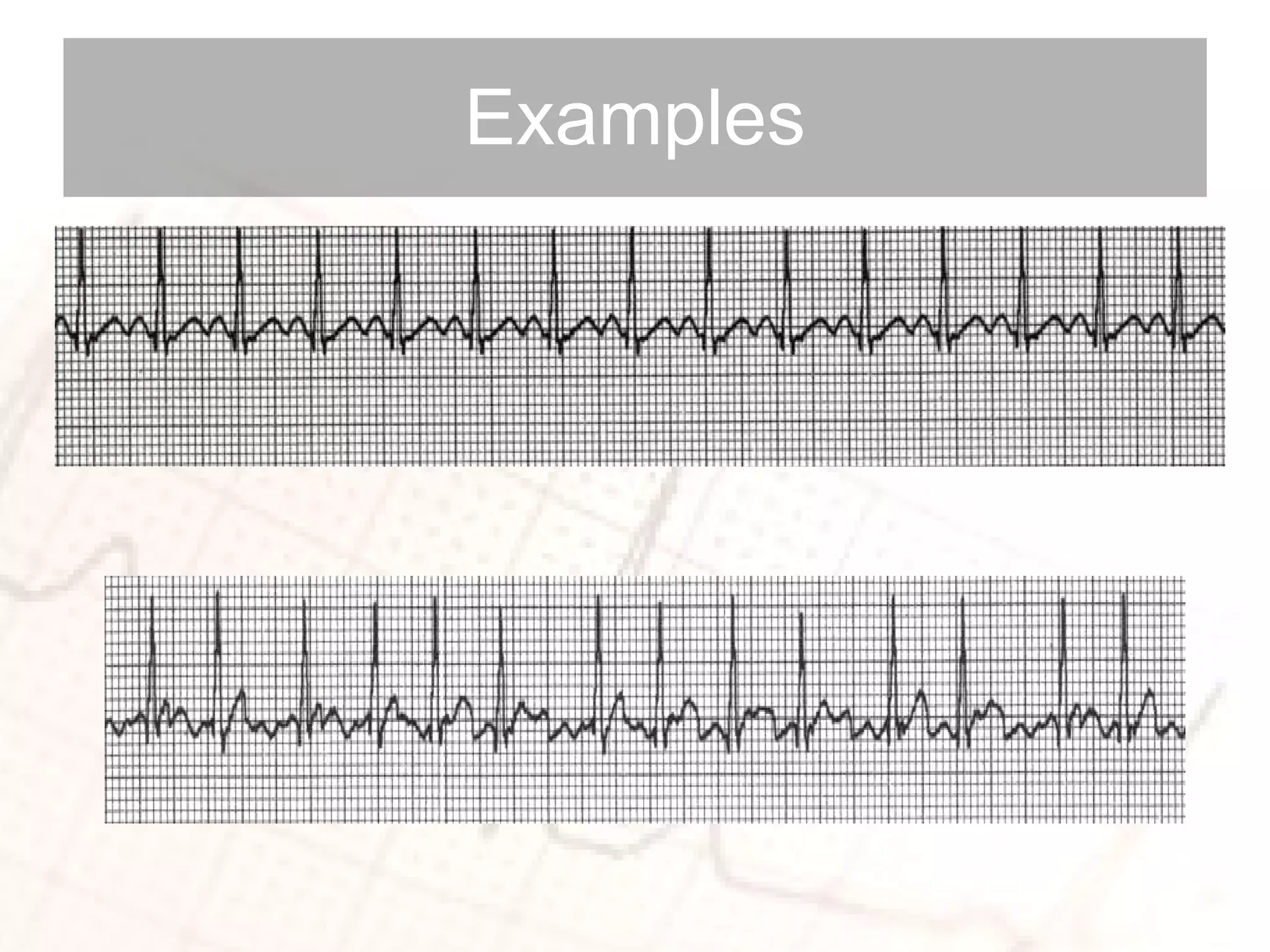 ECG interpretation: the basics | PPT