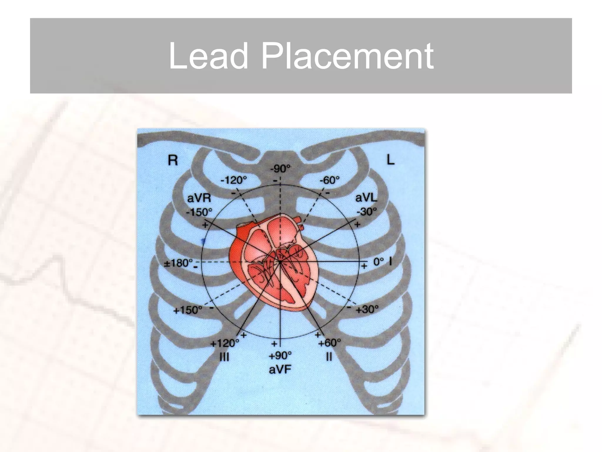 ECG interpretation: the basics | PPT