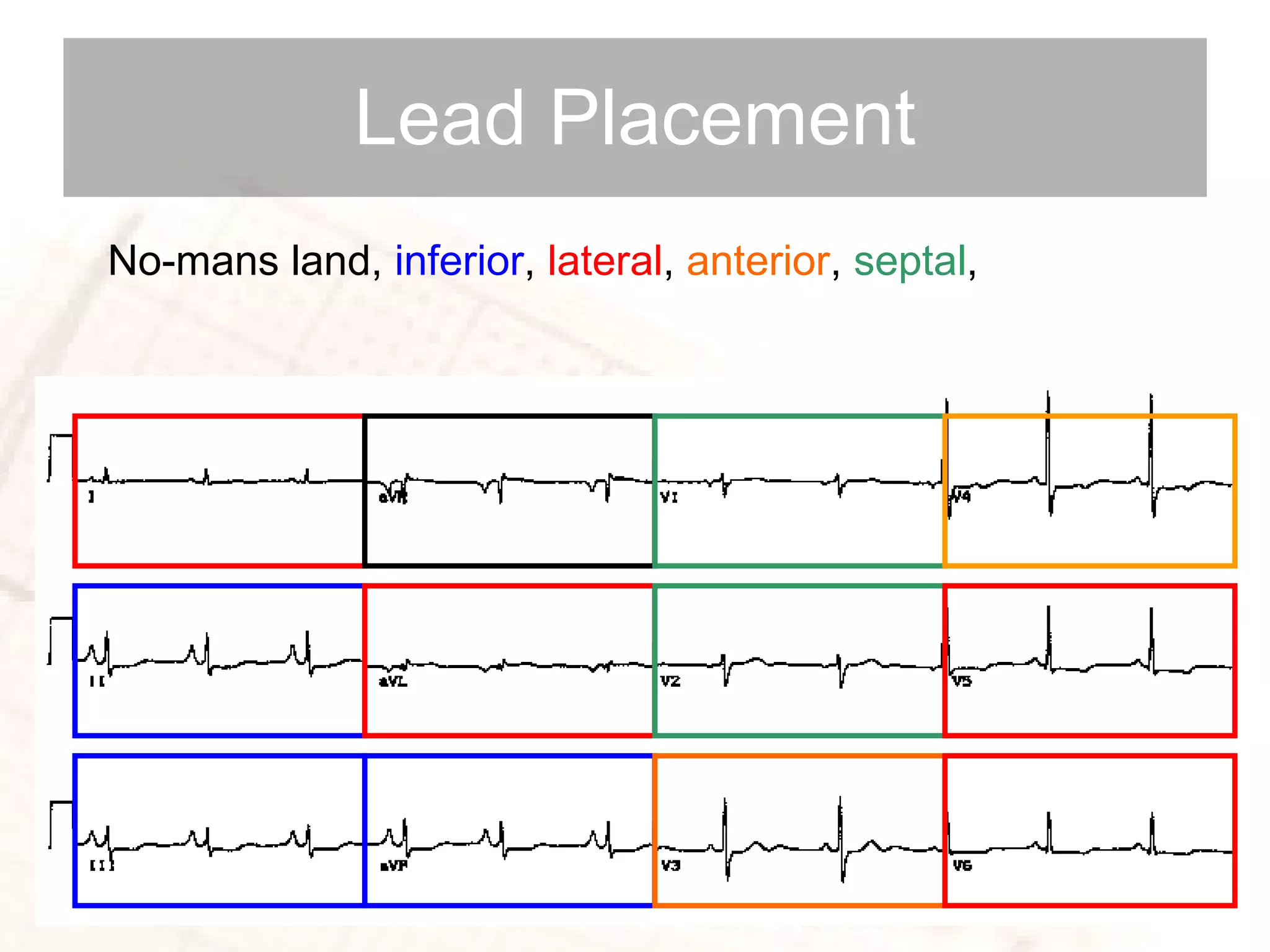 ECG interpretation: the basics | PPT