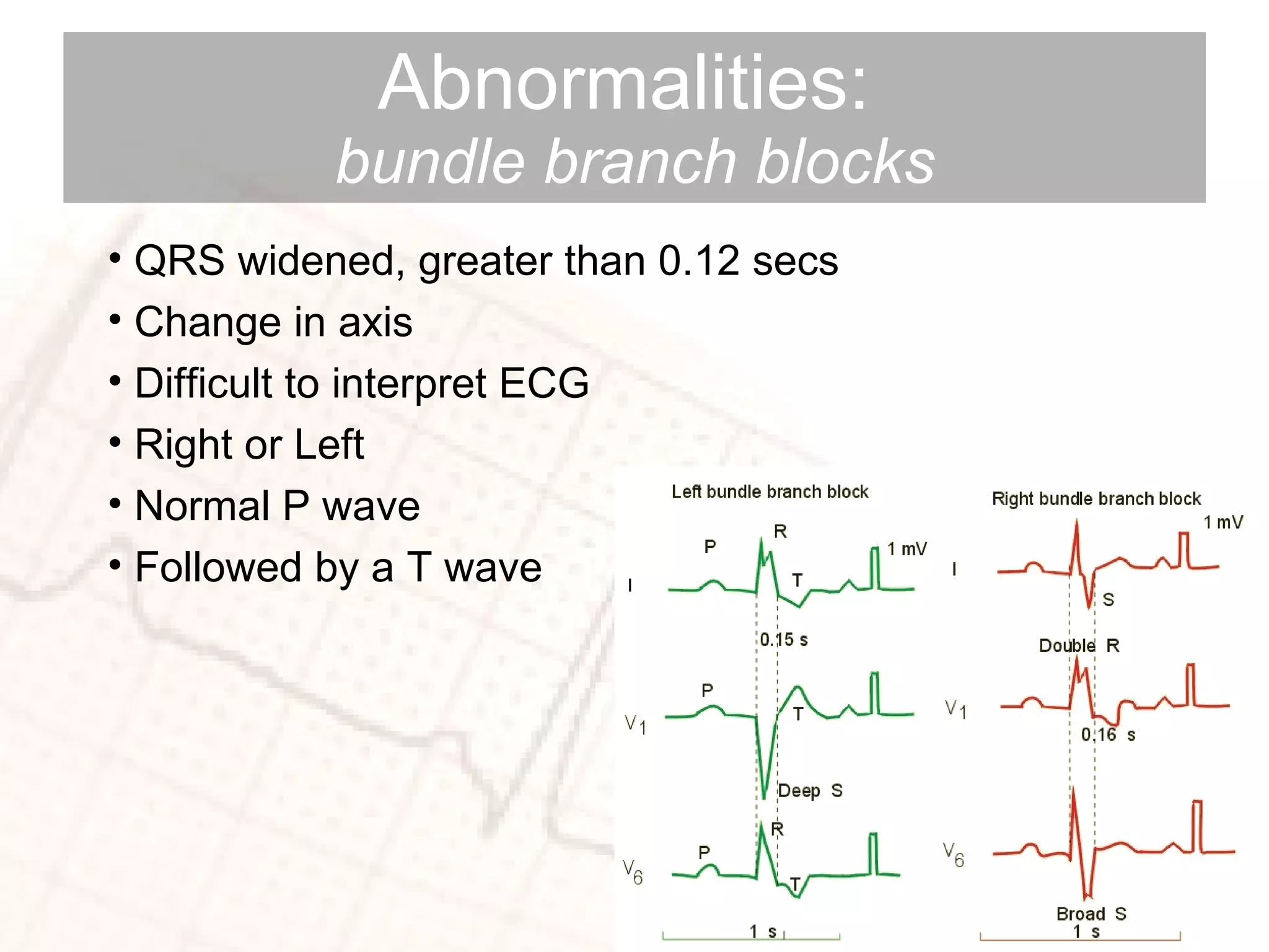 ECG interpretation: the basics | PPT