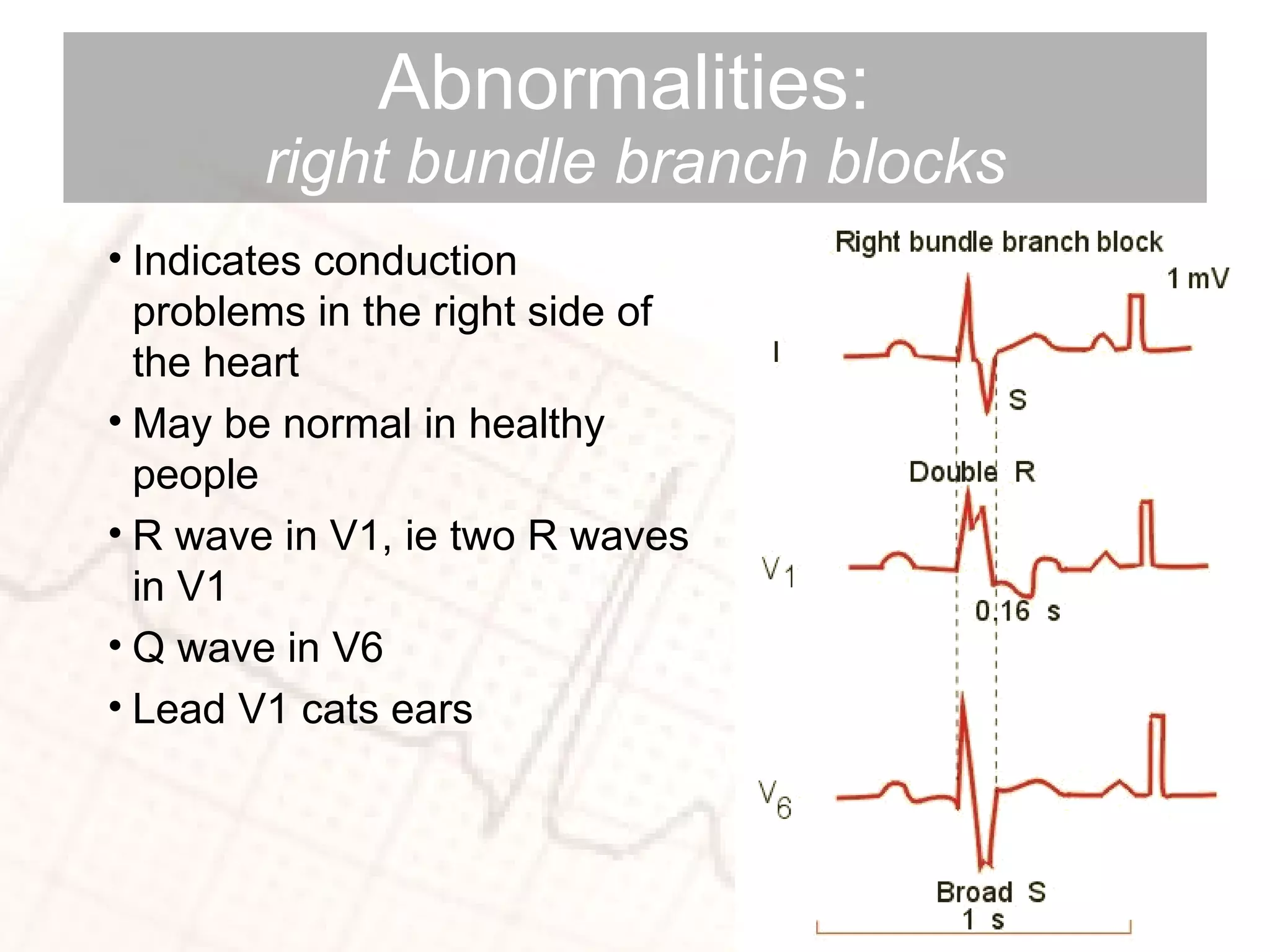 ECG interpretation: the basics | PPT