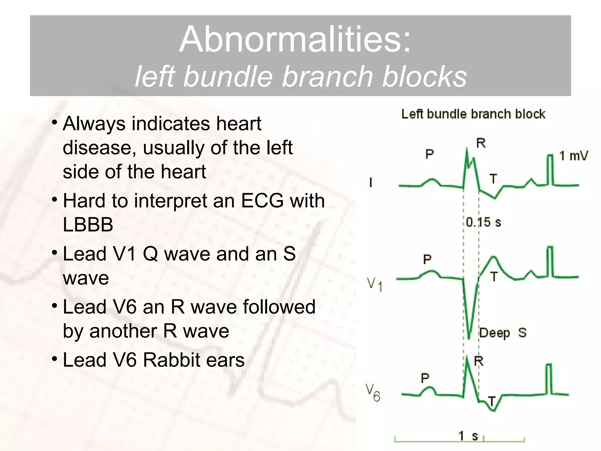 ECG interpretation: the basics | PPT