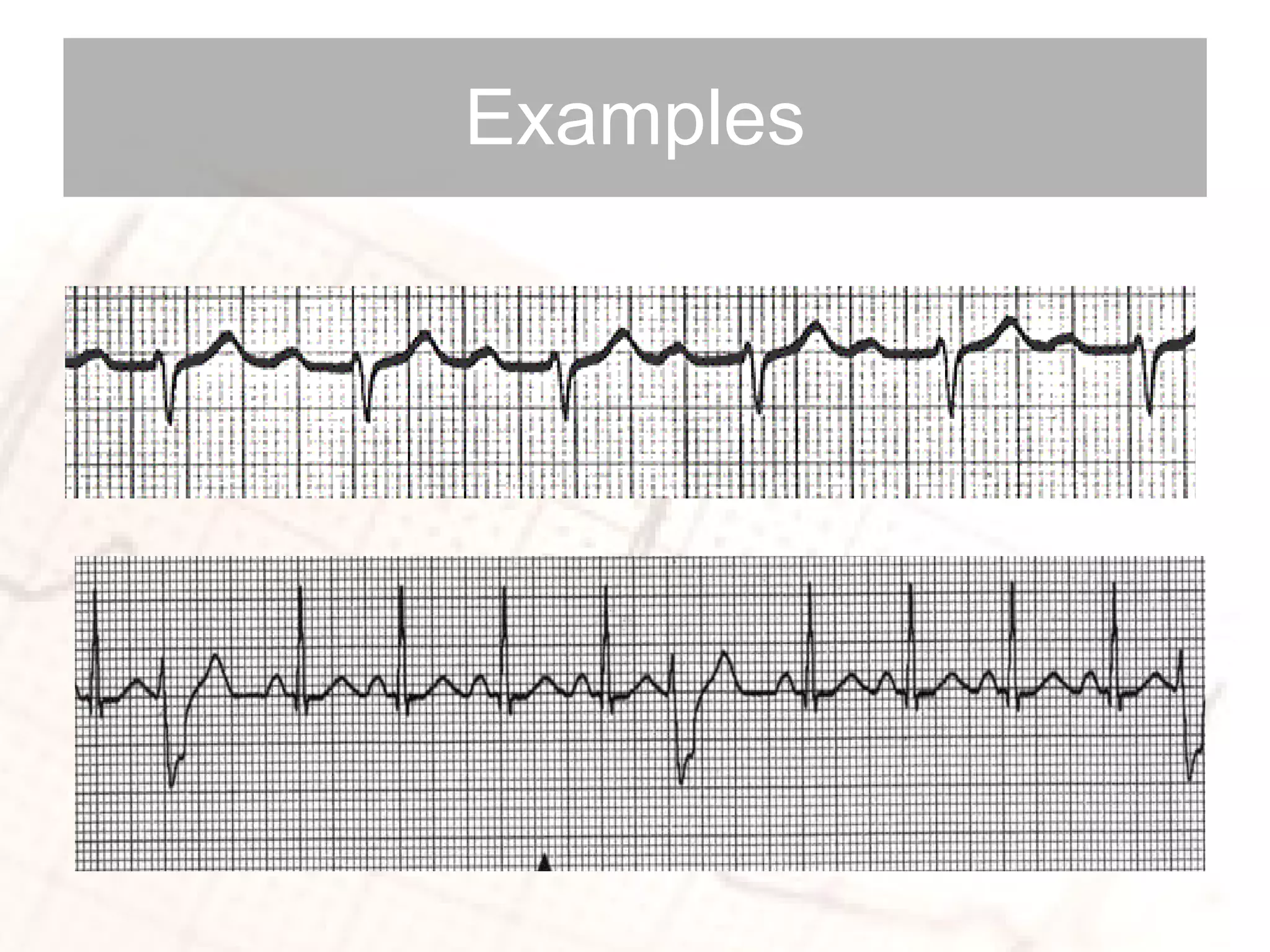 ECG interpretation: the basics | PPT