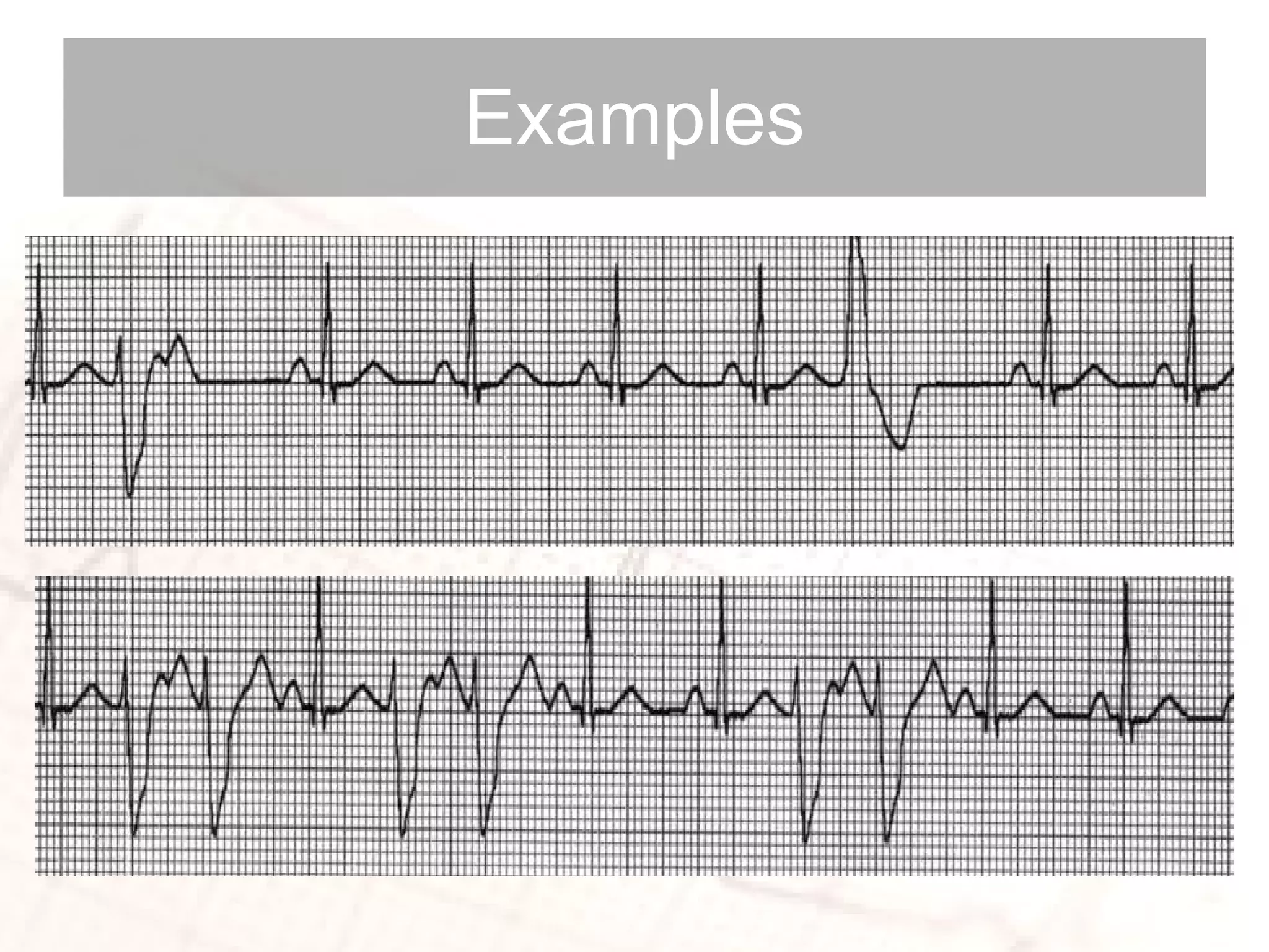 ECG interpretation: the basics | PPT