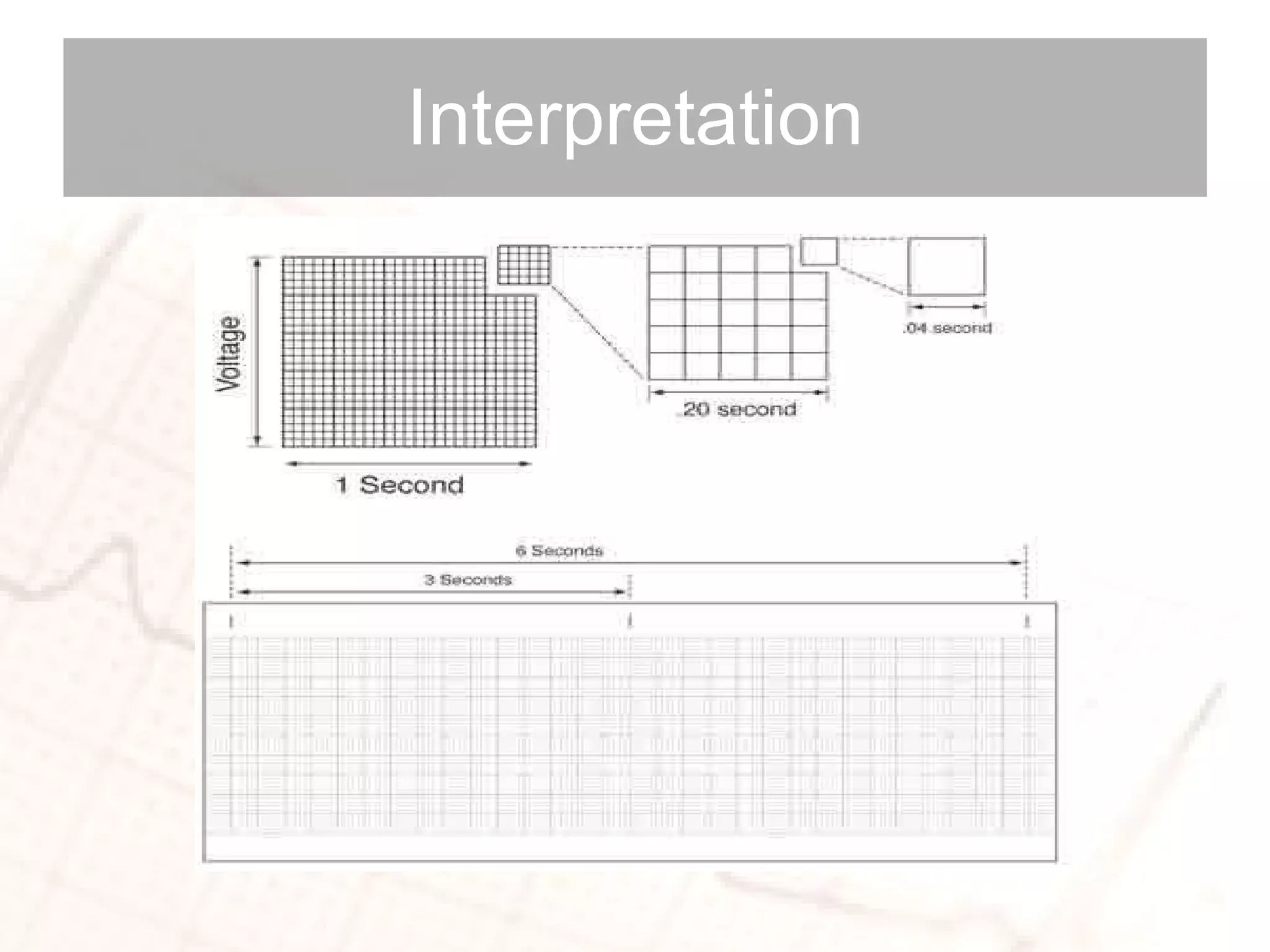 ECG interpretation: the basics | PPT