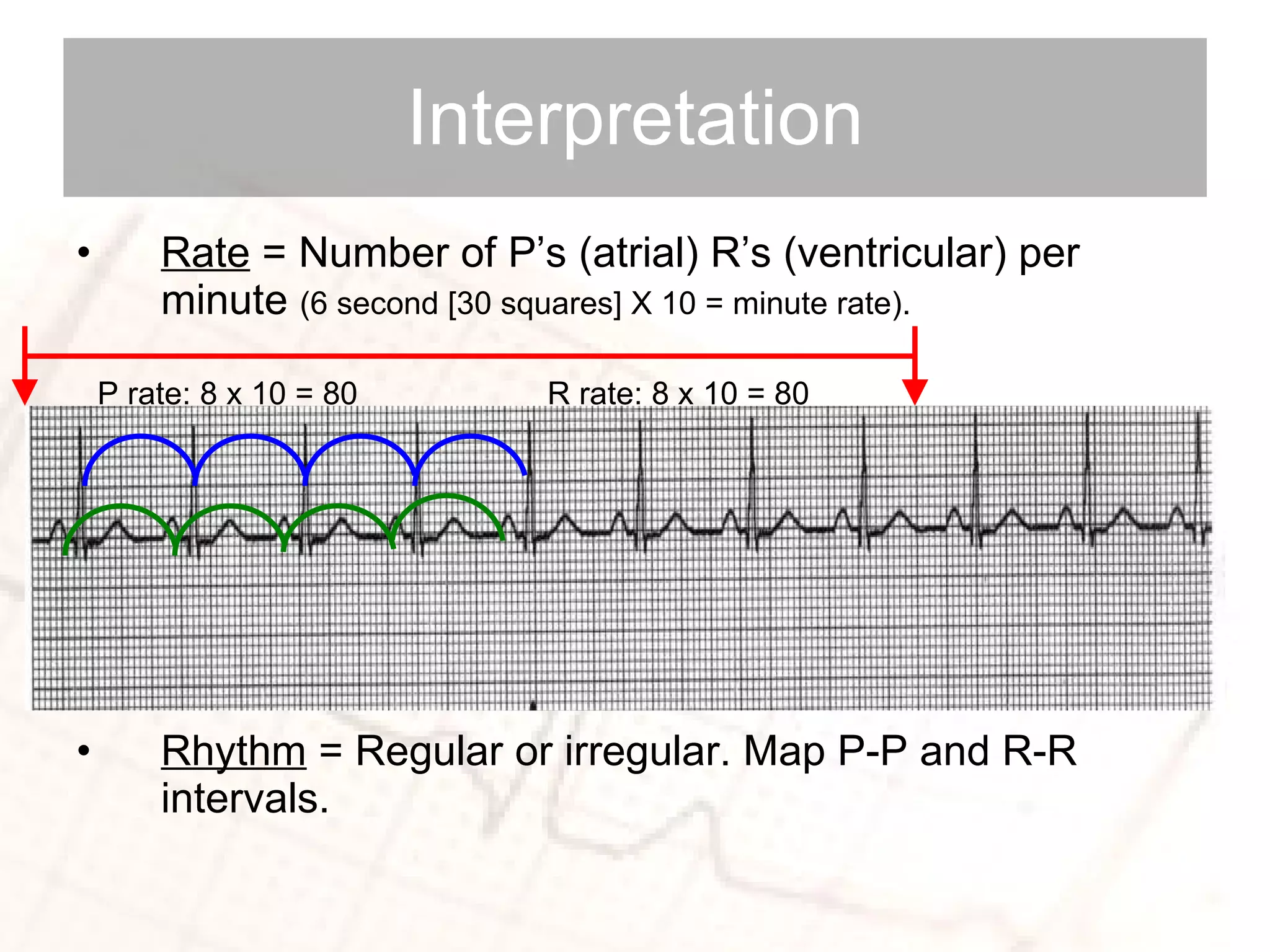 ECG interpretation: the basics | PPT