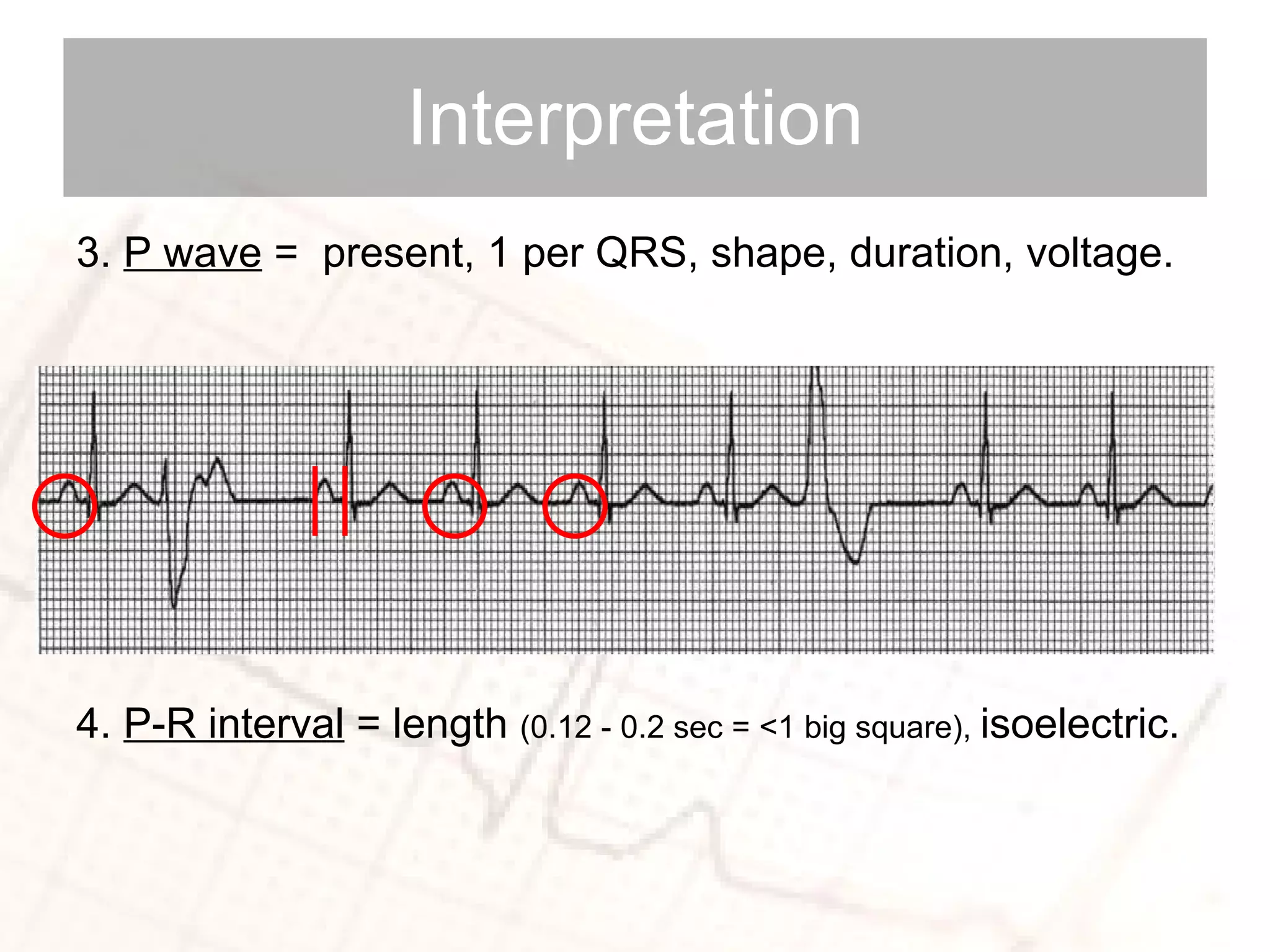ECG interpretation: the basics | PPT