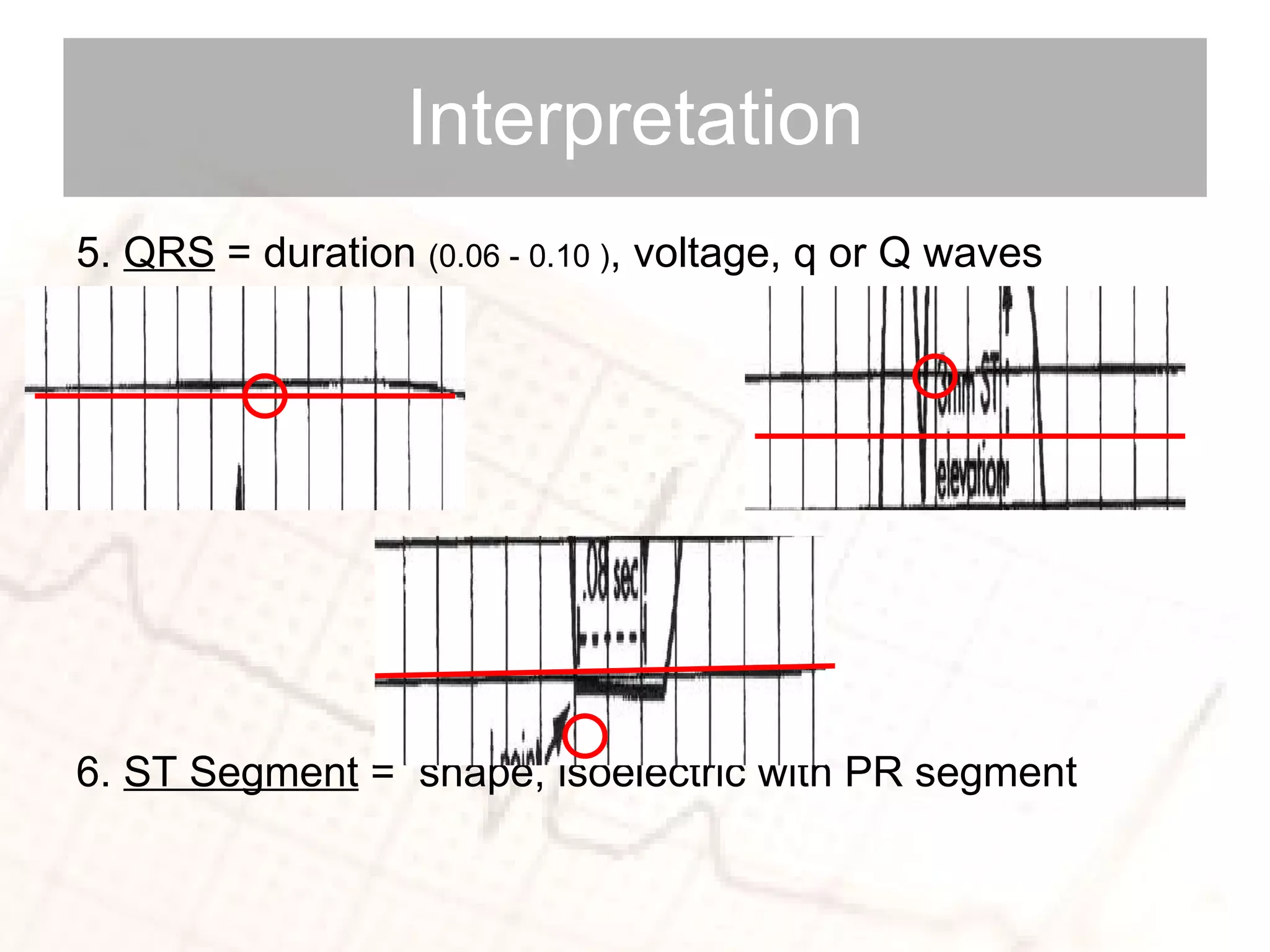 ECG interpretation: the basics | PPT