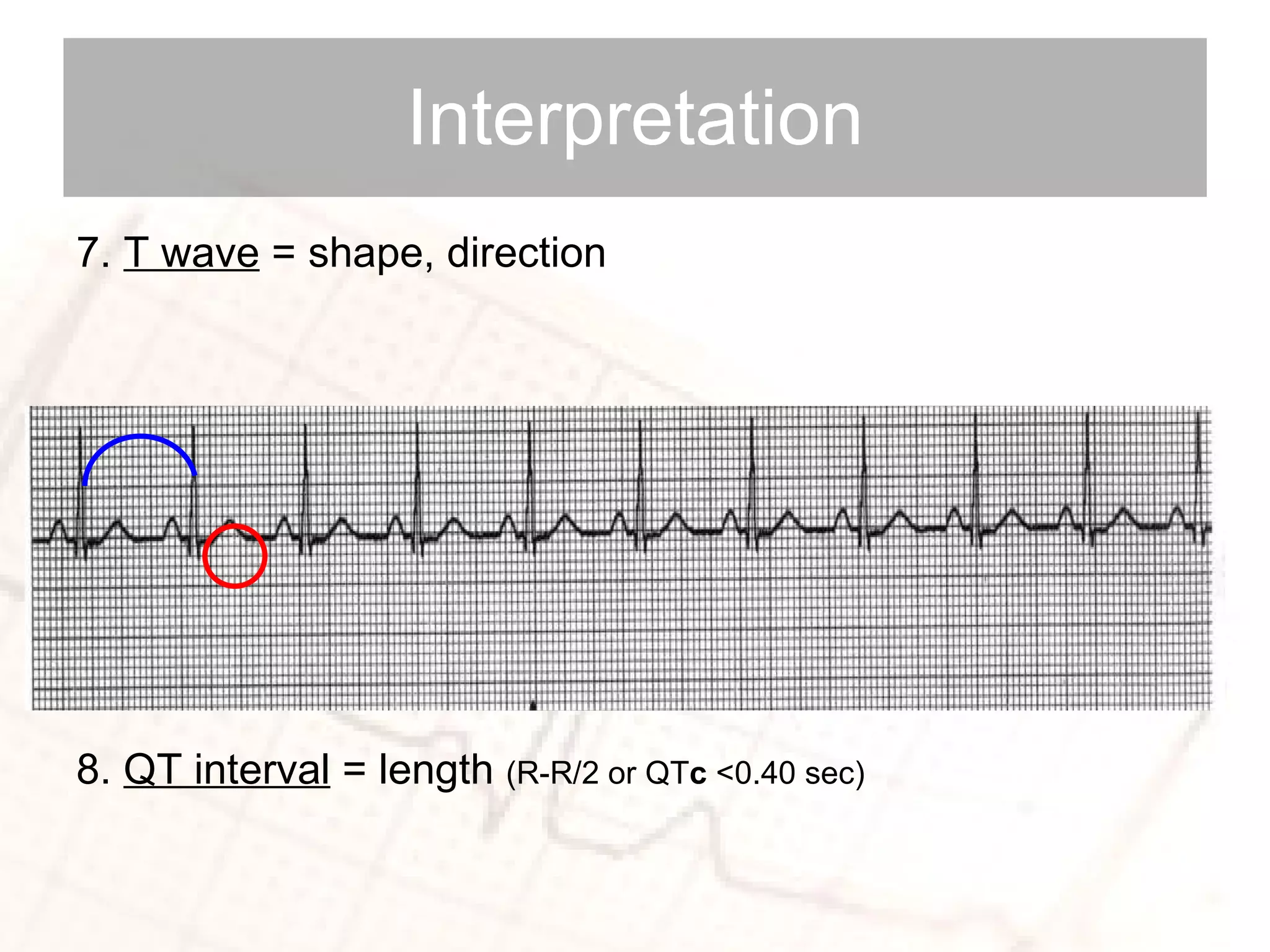 ECG interpretation: the basics | PPT