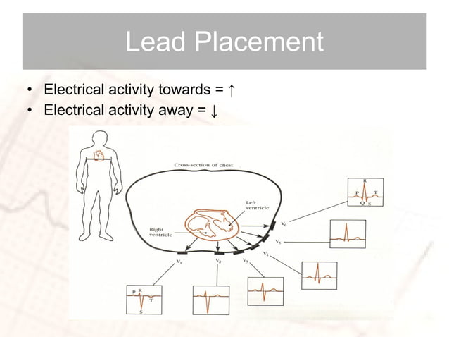 ECG interpretation: the basics | PPT