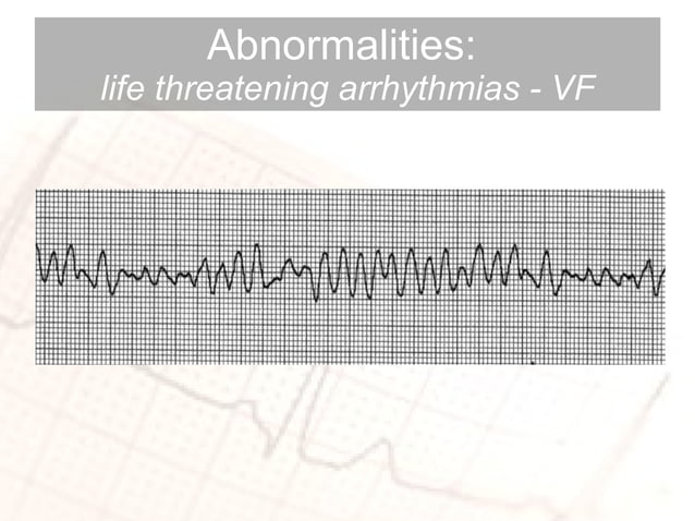 ECG interpretation: the basics | PPT