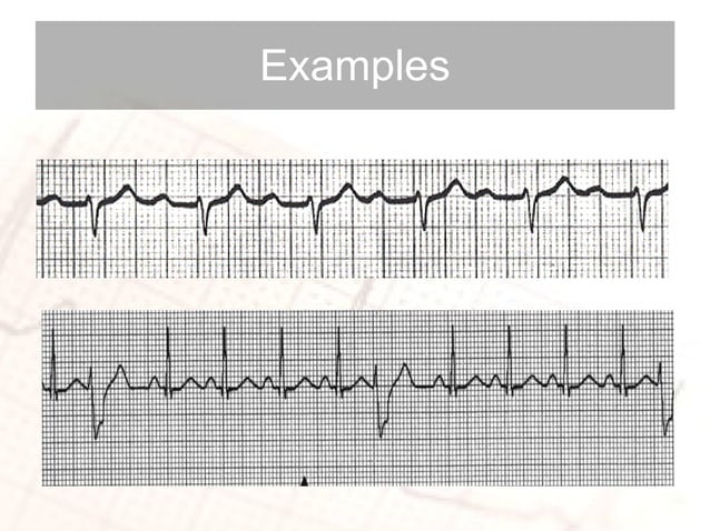 ECG interpretation: the basics | PPT