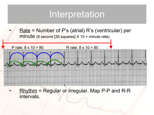 ECG interpretation: the basics | PPT