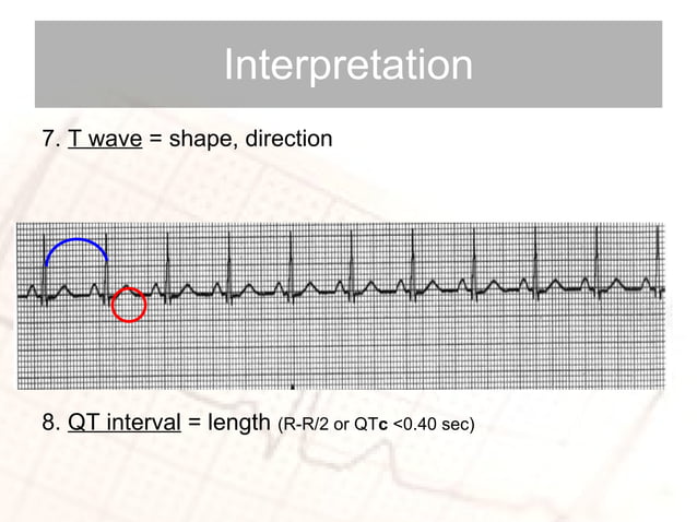 ECG interpretation: the basics | PPT