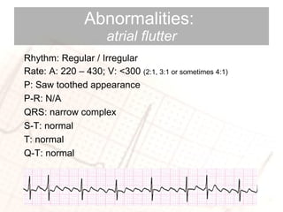 Abnormal Ecg Examples