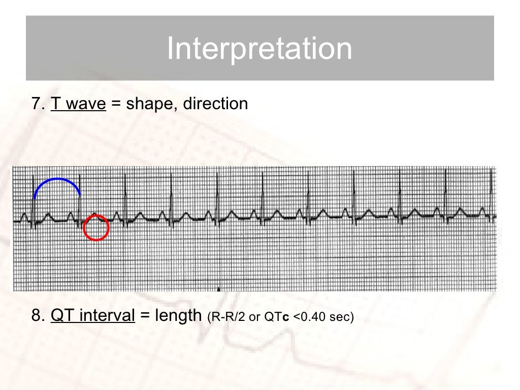 ECG interpretation: the basics