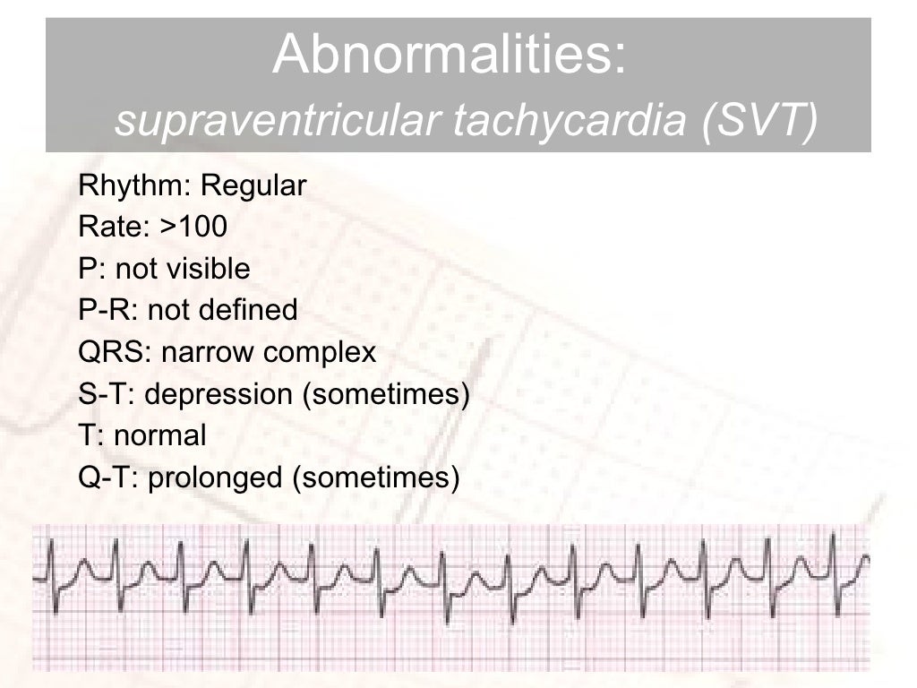ECG interpretation: the basics