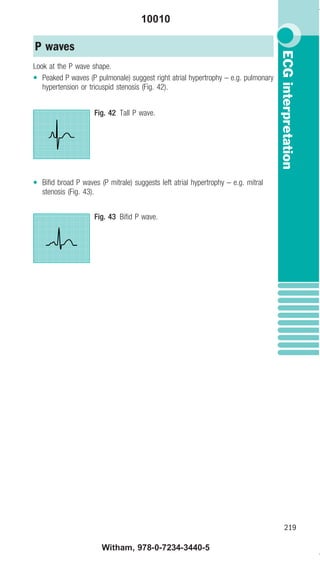 Ecg | PDF