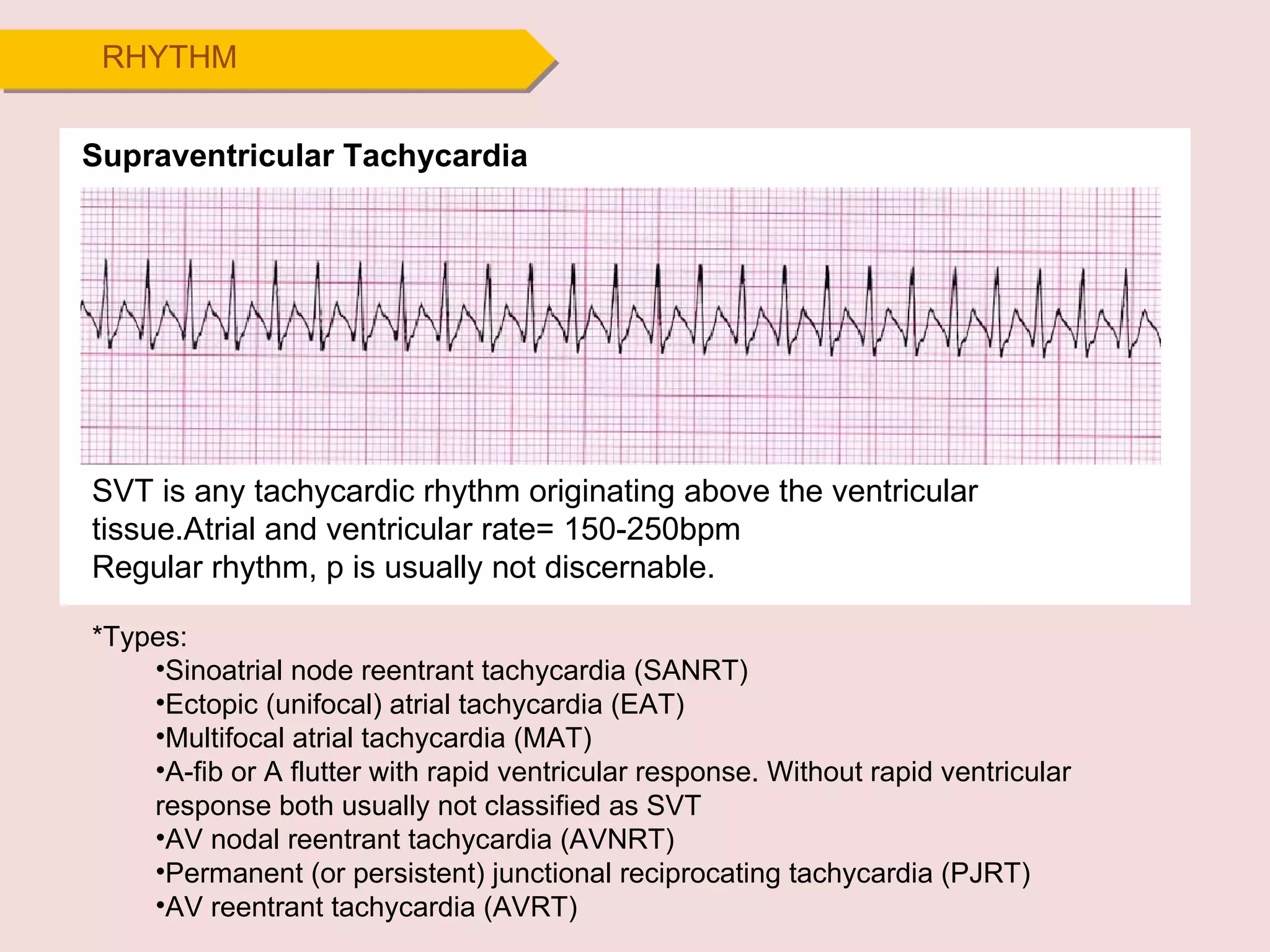 ECG | PPT