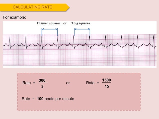 ECG | PPT | Heart and Cardiovascular Diseases | Diseases and Conditions