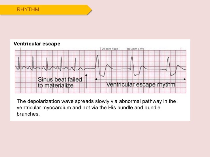 ECG