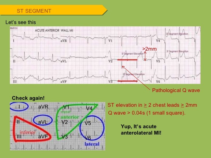 ECG