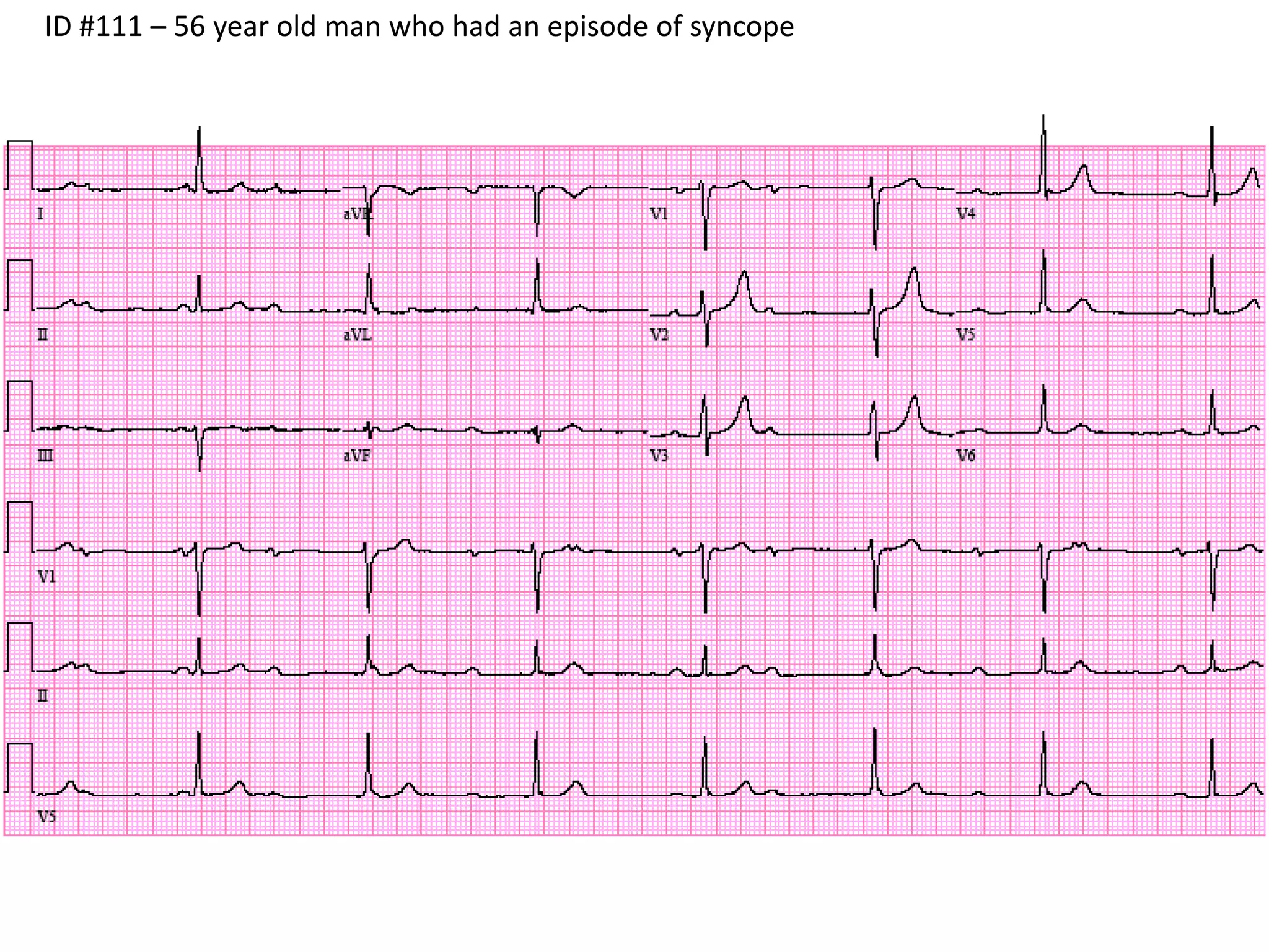 Ecg 12 Id 111 Chb Pptx