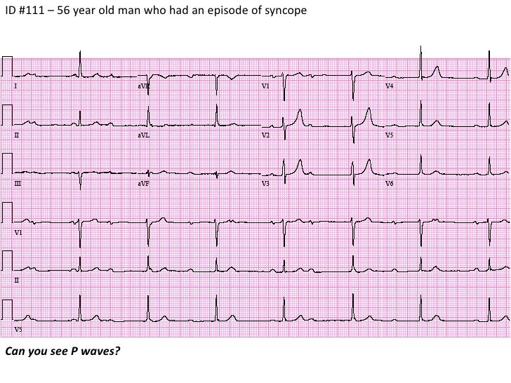 ECG #12 - ID 111 - CHB