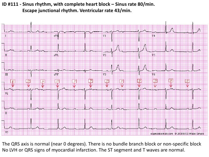 ECG #12 - ID 111 - CHB