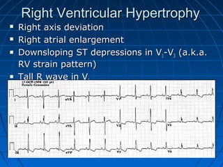 ECG | PPT