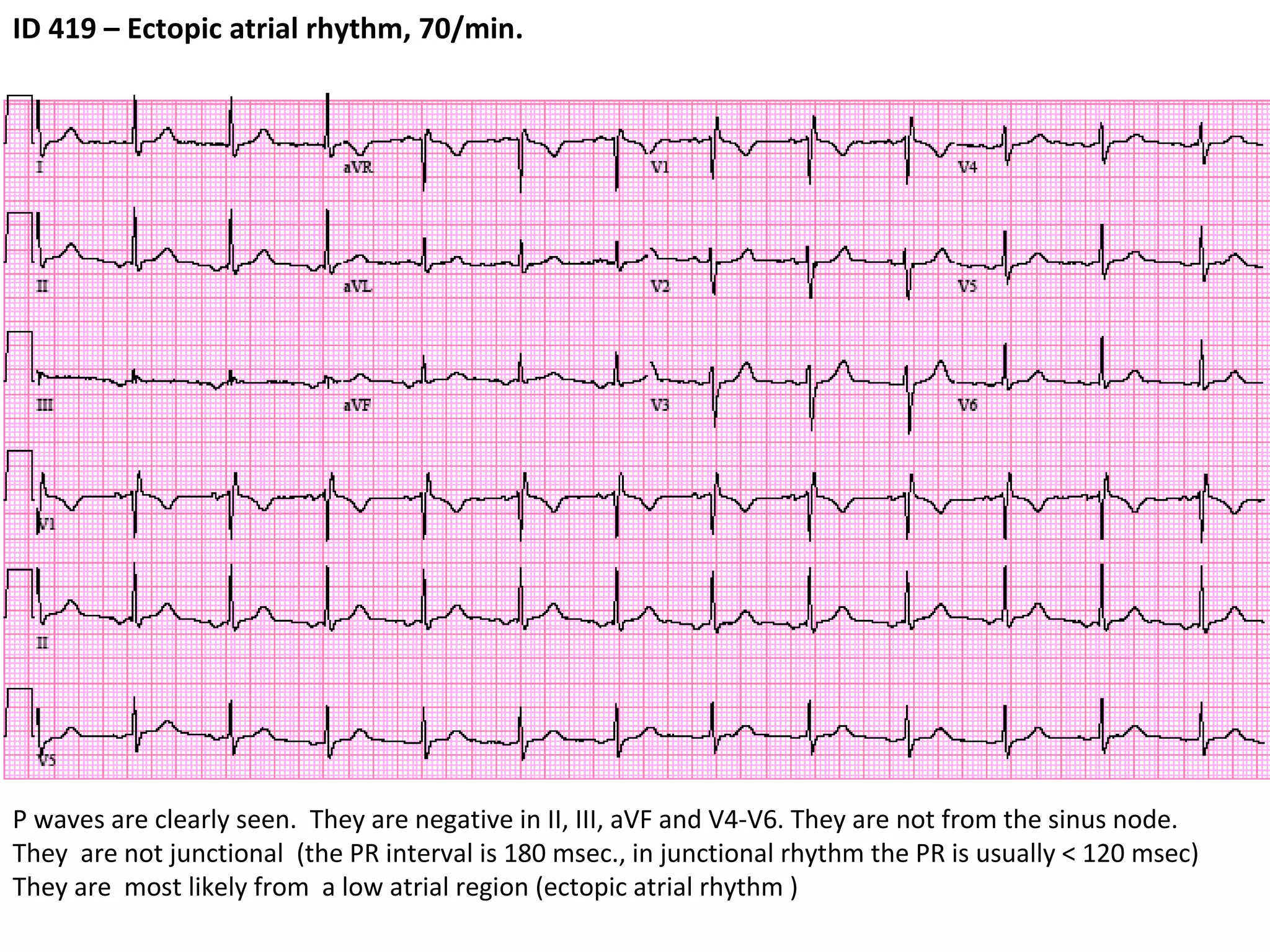 ECG #13 - ID 419 - EAR IRBBB | PPT
