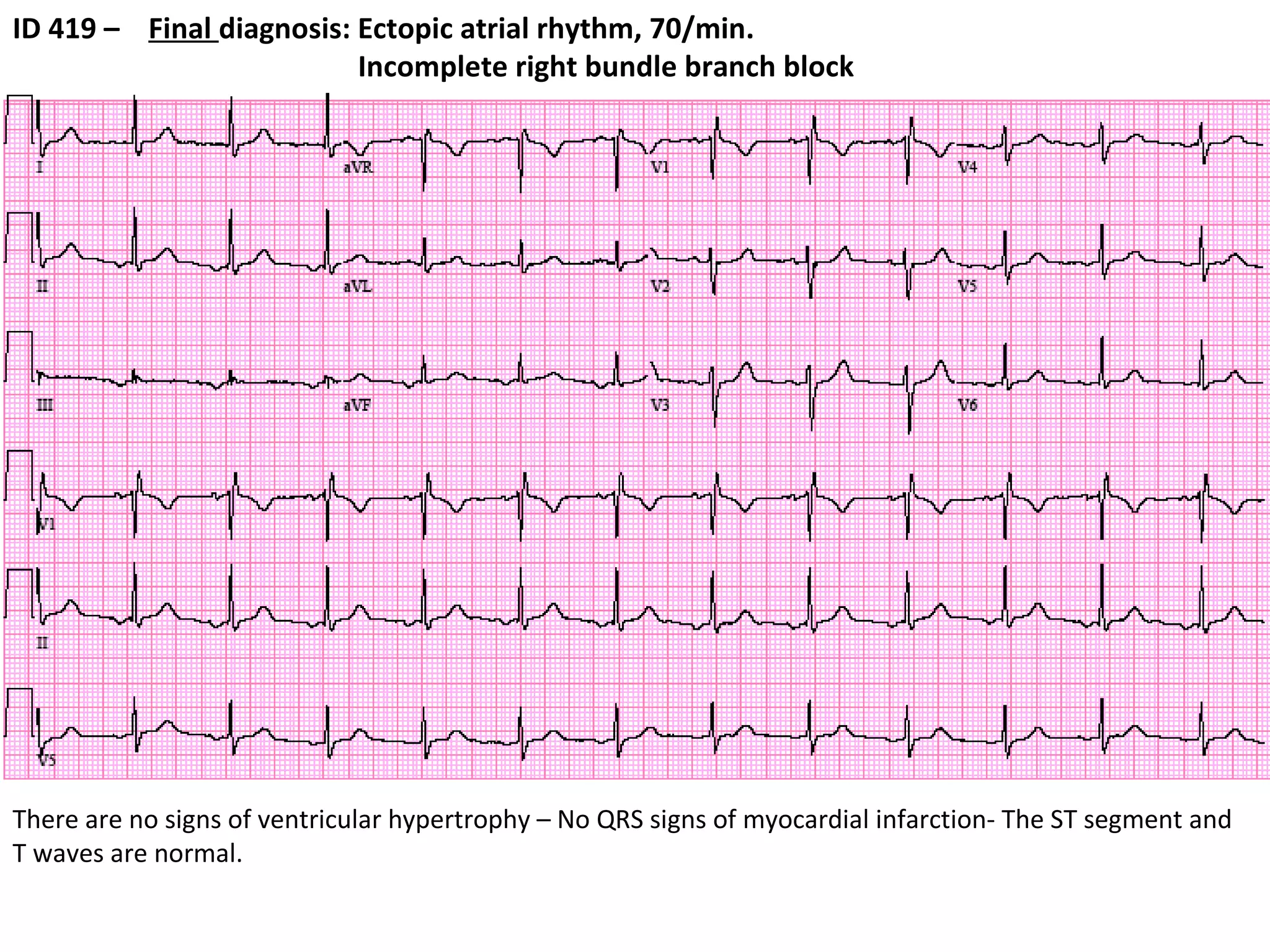 ECG #13 - ID 419 - EAR IRBBB | PPT