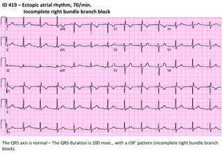 ECG #13 - ID 419 - EAR IRBBB | PPT