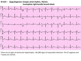 ECG #13 - ID 419 - EAR IRBBB | PPT