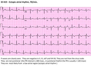Ectopic Atrial Tachycardia Ecg